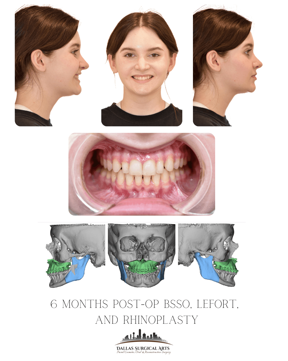 Jaw Repositioning (Orthognathic Surgery) | Dallas Surgical Arts